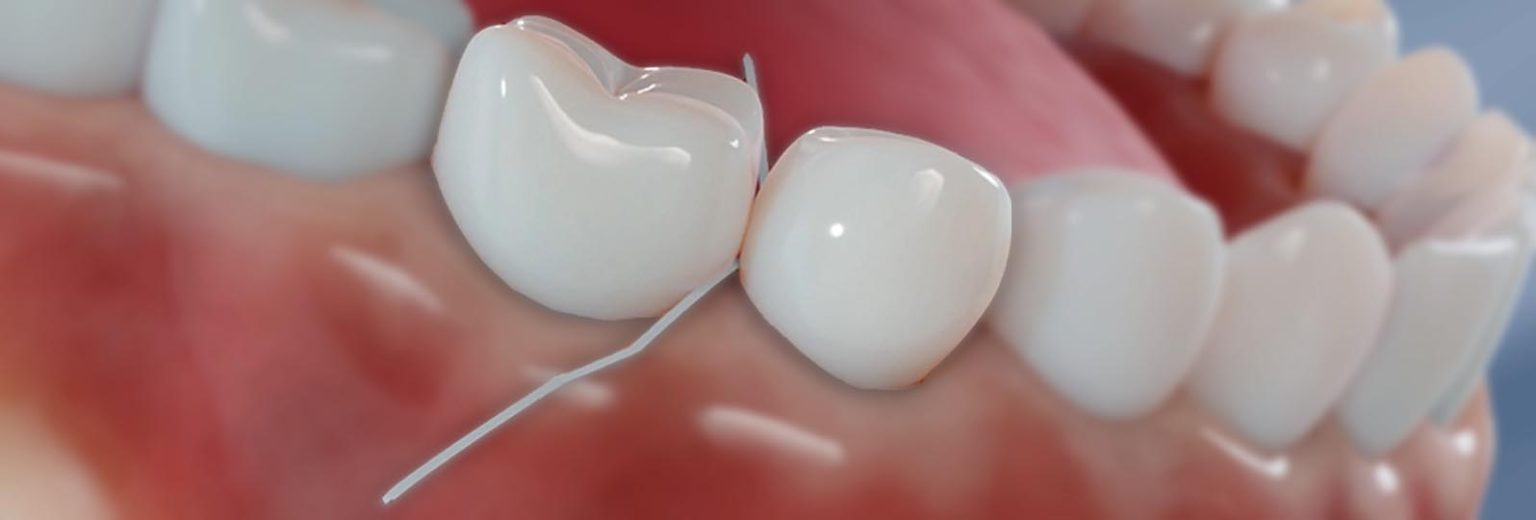Beyond Brushing: How to Floss with Proper Technique - Parkway Dental Group